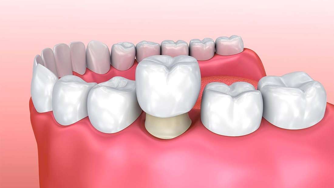 How to Prevent Cavities within Dental Crowns | Winston-Salem, NC
